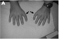 Townes-Brocks and Okihiro Syndrome | Max Delbrück Center