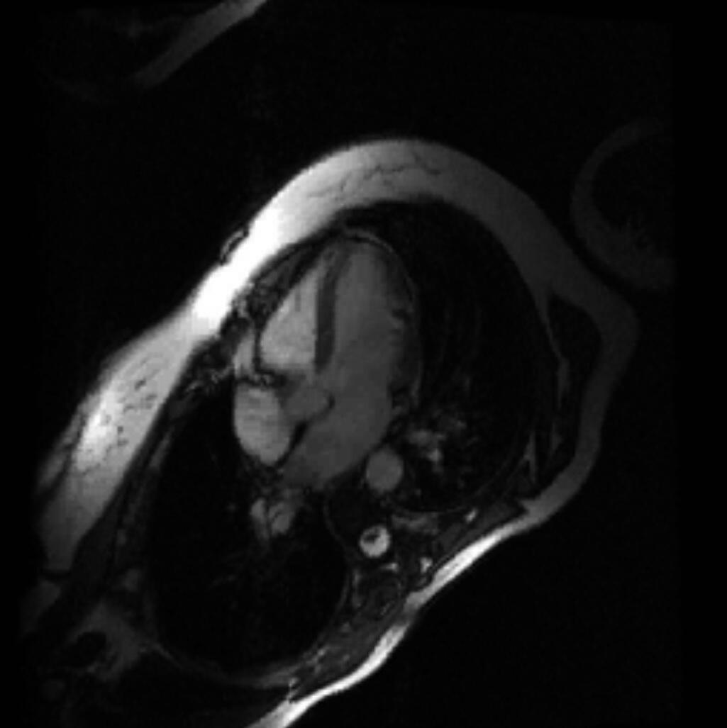 What a waste! The molecular causes of muscle wasting in heart failure ...