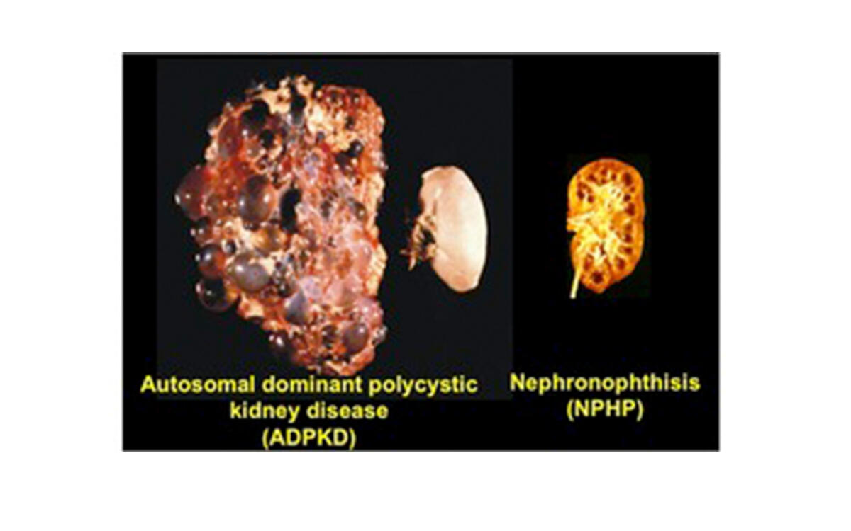 Nephronophthisis and GLIS2 | Max Delbrück Center for Molecular Medicine