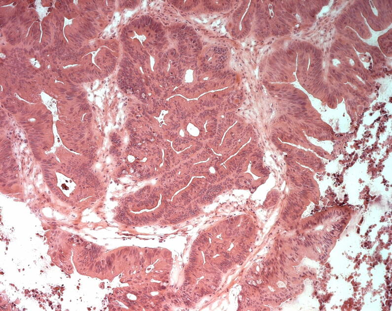 Die Signaturen der Bauchfell-Metastasen | Max Delbrück Center